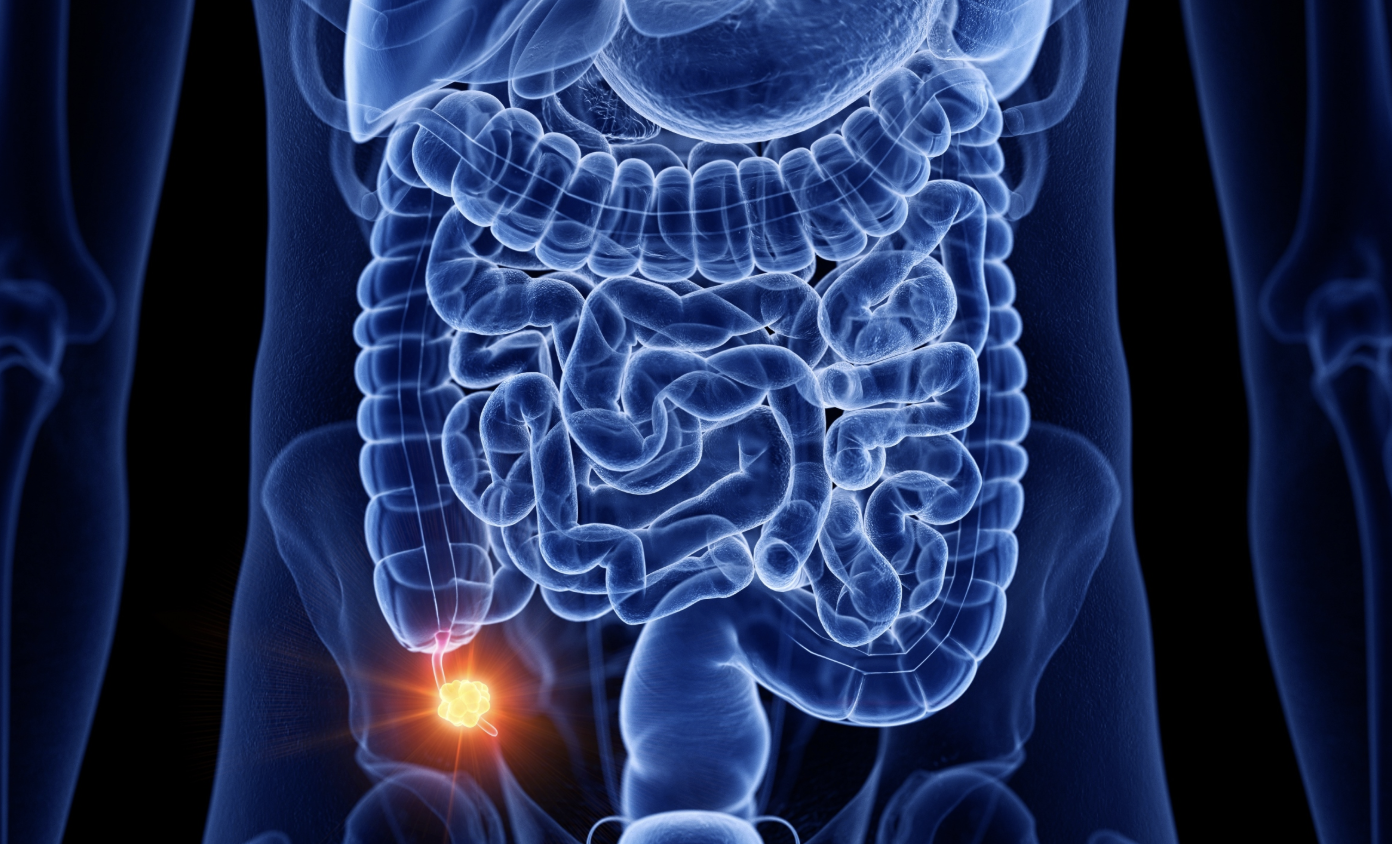 Understanding Appendix Cancer: Symptoms, Causes, and Care